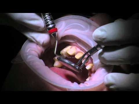 3 - Tooth Preparation
