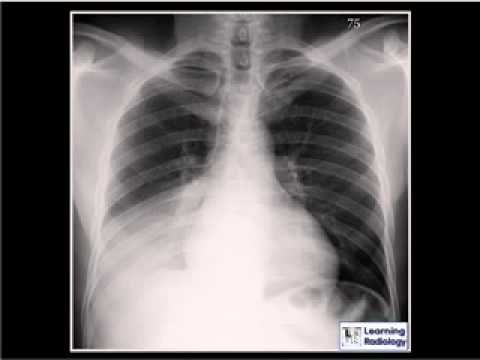 Signo de la silueta | Radiología Universidad Oviedo