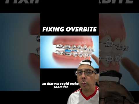 How to Properly Fix an Overbite with Braces | View Mobile Dental #shorts