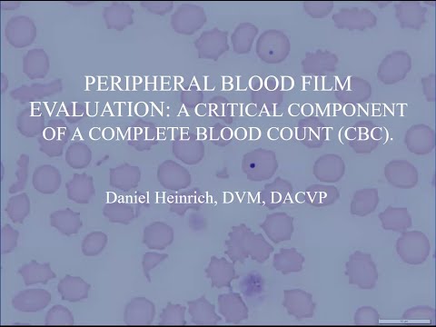 Peripheral blood film evaluation: a critical component of a complete blood count (CBC)