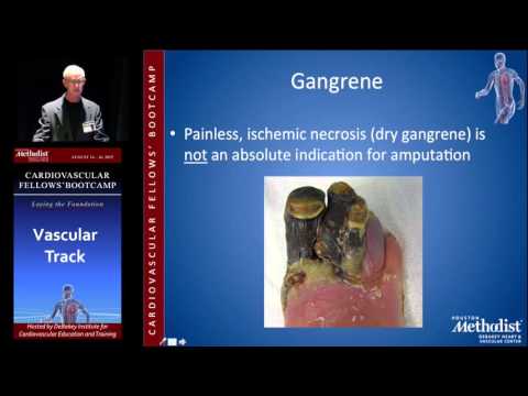 Amputations (John Eidt, MD)