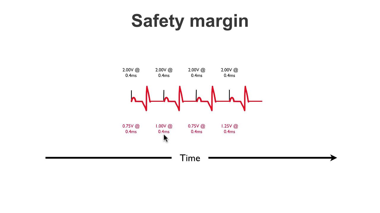 Pacemaker Issues Explained (Part 1): Understanding Failure to Capture