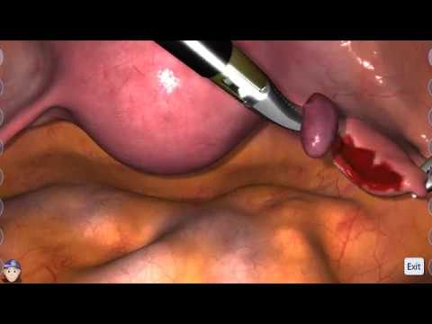 LapSim Gynecology: Salpingotomy