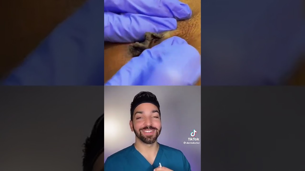 Giant cyst!!! #pimplepopping dermdoctor #shorts