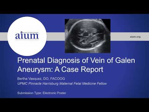 Prenatal Diagnosis of Vein of Galen Aneurysm: A Case Report