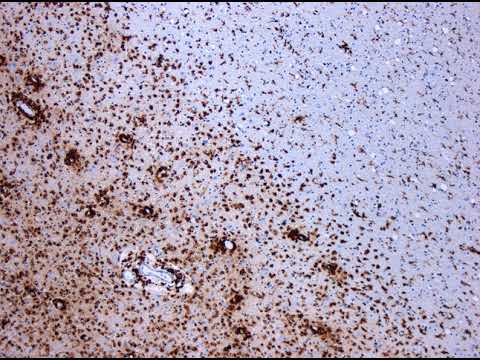 Multiple sclerosis | Wikipedia audio article