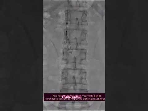 IVC filter placement #cardiology #angiogram #art #education #foryou