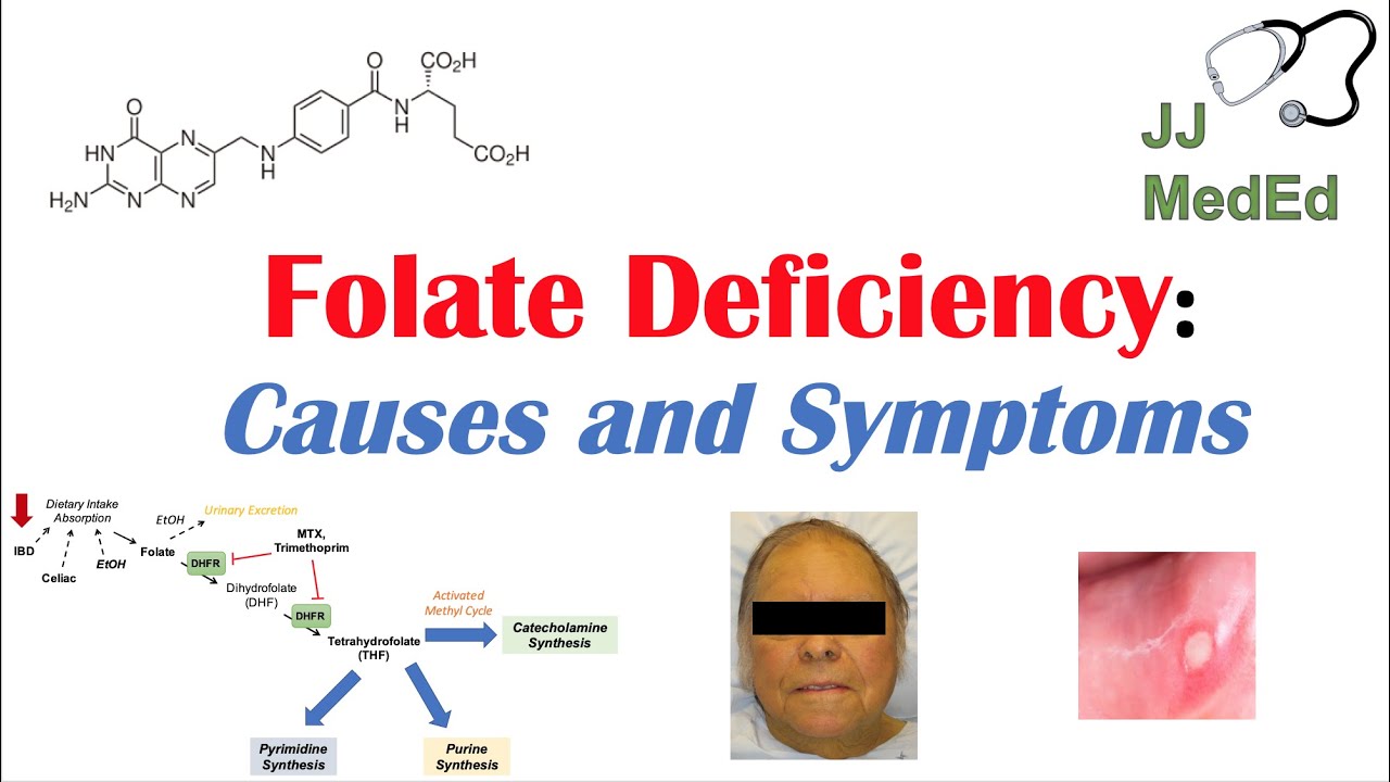 Folate Deficiency, Causes (ex. medications), Pathogenesis, Symptoms, Diagnosis and Treatment