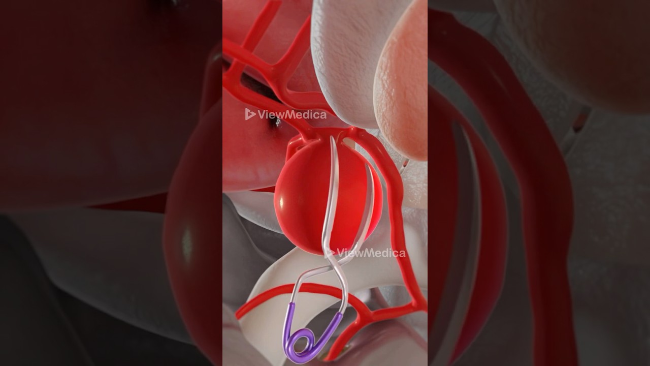 Brain Aneurysm Clipping (3D Animation)