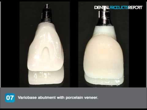 How to obtain esthetics, precision and biologic stability with implant restorations