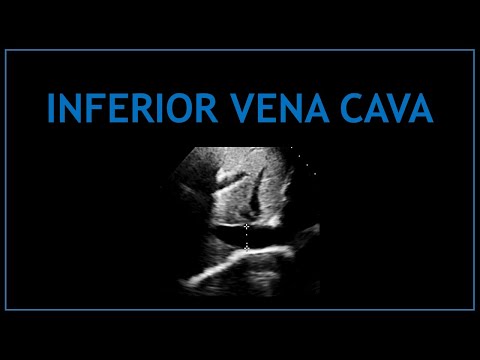 Inferior Vena Cava (IVC- Echocardiography)!