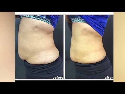 Cryo One therapy at Laser Loft Medical Spa | River City Live