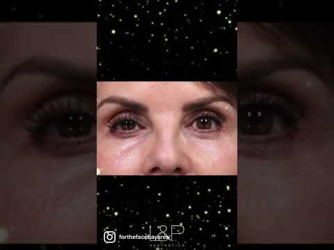 Beautiful Bay Area Blepharoplasty | Dr. Lieberman and Dr. Parikh