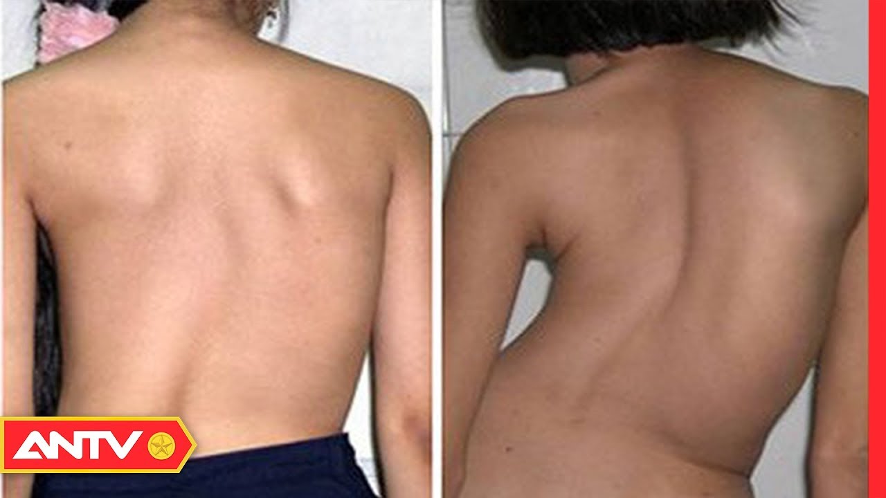 Cong vẹo cột sống - bệnh phổ biến ở cả người lớn và trẻ em | SKMN | ANTV