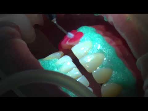 Smartbleach 3LT teeth whitening