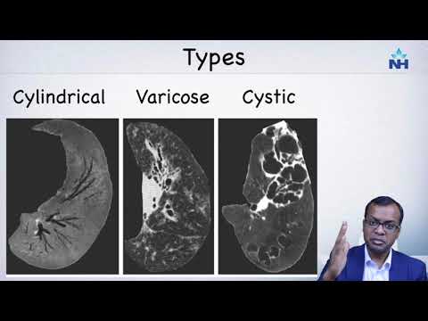 CT imaging and diagnosis of Bronchiectasis