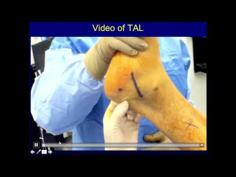 Achilles Tendon Lengthening