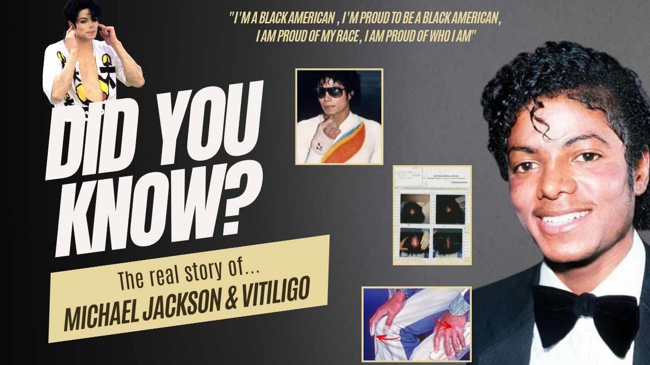 The real story of Michael Jackson and Vitiligo