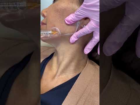 Jawline Filler