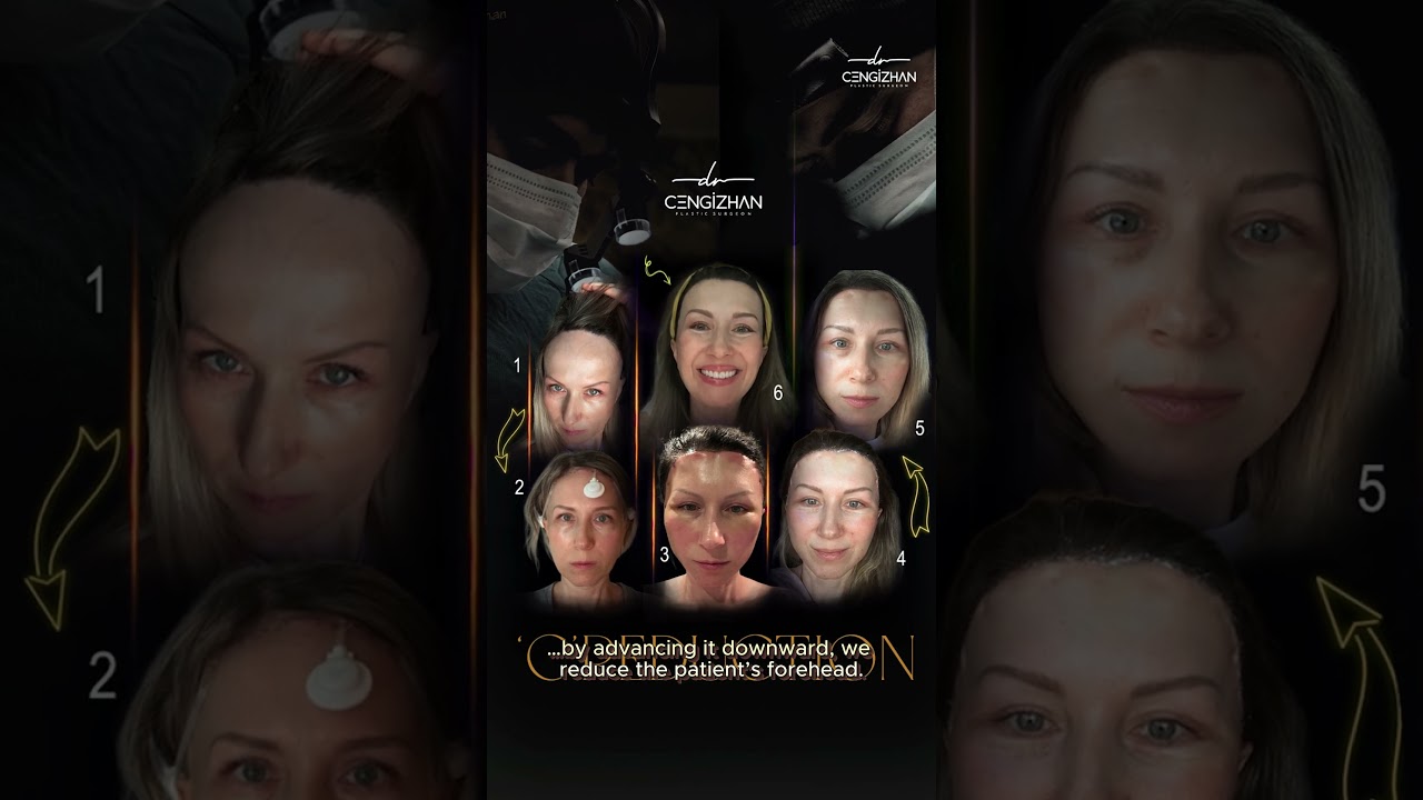 What Is Forehead Reduction & Who Is It Suitable For? ✨