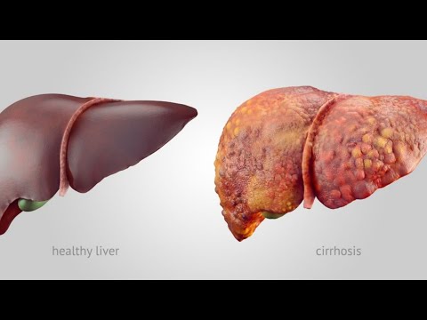 NAFLD/NASH