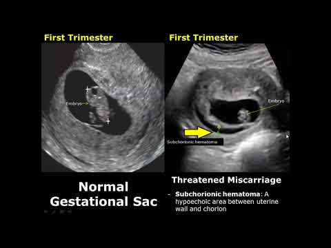 Uterus Ultrasound Normal Pregnancy Vs Miscarriage Image Appearances | Intrauterine Pregnancy USG