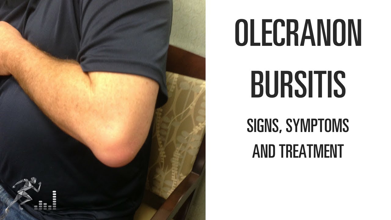 Olecranon bursitis: Signs, symptoms and treatment of the elbow problem
