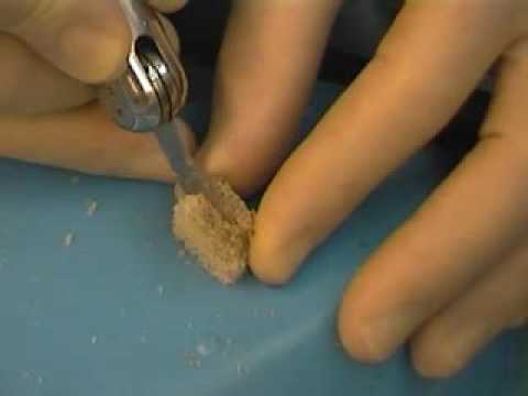 Fusion of an arthritic 2nd metatarsocuneiform joint by Tim Kilmartin Foot Surgery Services