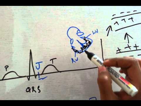 J Point ECG Discussion - Basics of Injury Potential