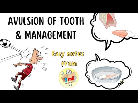 AVULSION - TRAUMATIC INJURIES OF TOOTH - MANAGEMENT #endodontics