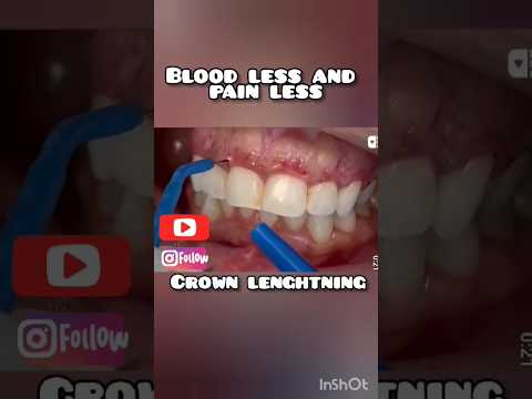 Painless and Bloodless Crown Lengthening with Electro Cautery #painlessdentistry #dentist #smile