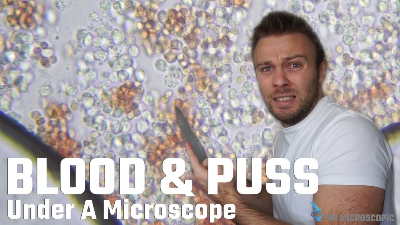 BLOOD & PUSS Under A Microscope