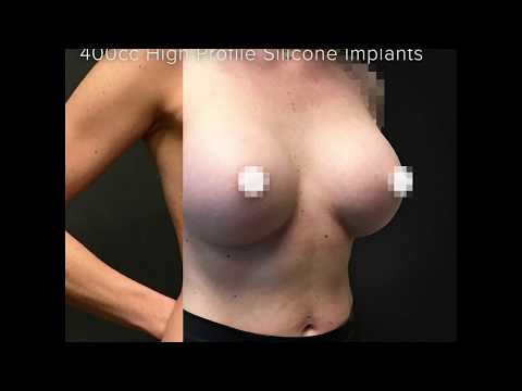 Amazing 400cc Gummy Bear Implants | Seattle Breast Augmentation
