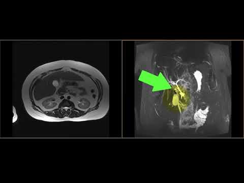 Gallbladder - Normal Anatomy - MRI Online