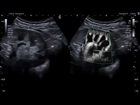 8. SMI - Kidney Slim Footprint 8C1 | Ultrasound Aplio a-series | Canon Medical Systems