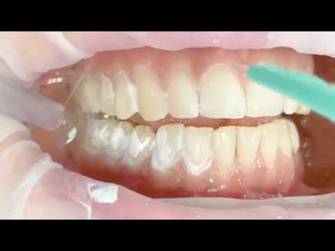 Hypersensitivity exposed dentin | Ghimas