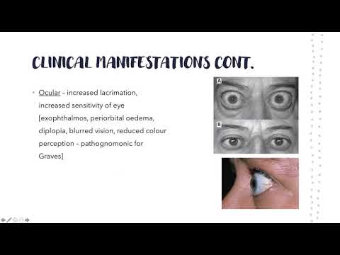 Hyperthyroidism - Medical Lecture Series