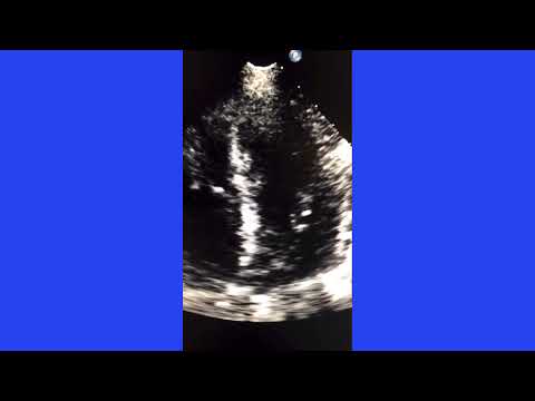 Constrictive Pericarditis