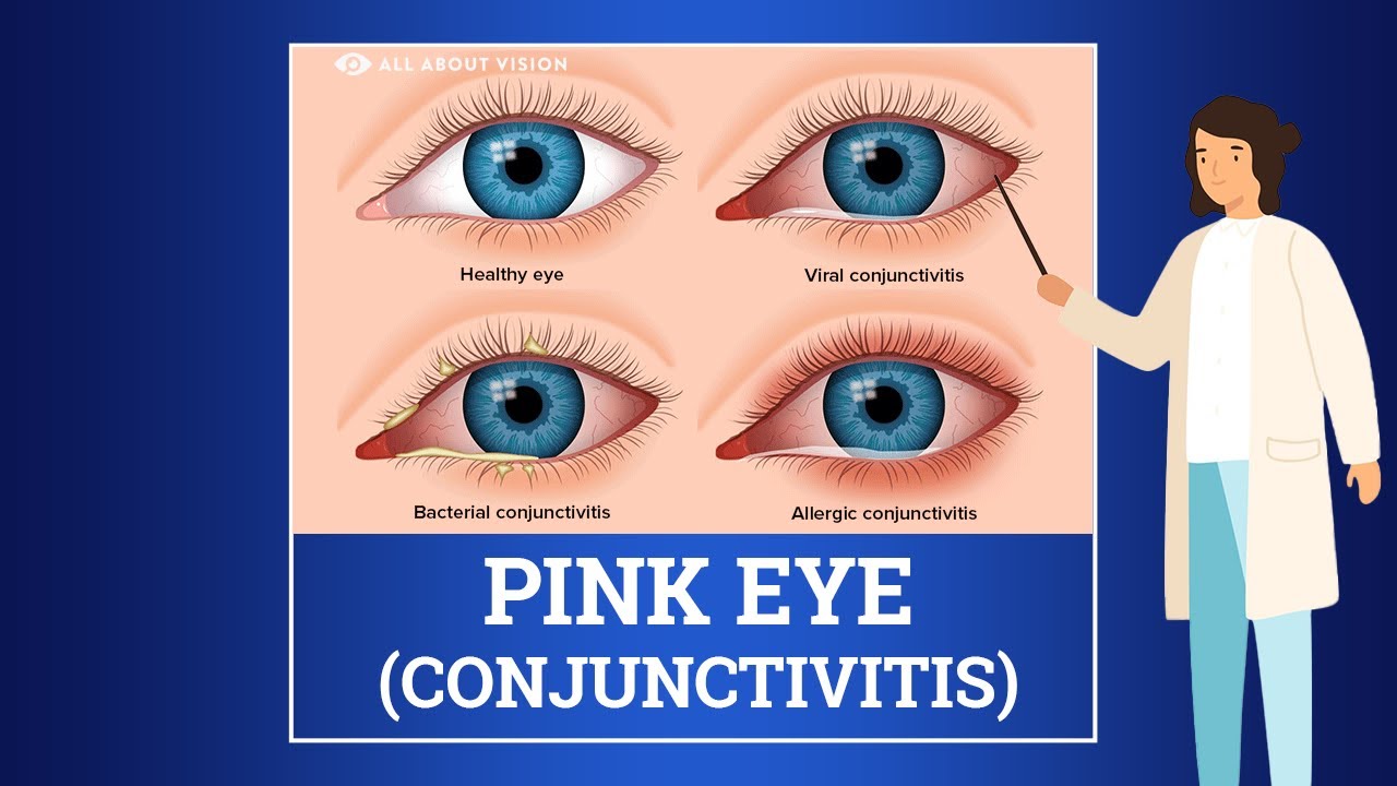 What is Pink Eye (Conjunctivitis)?