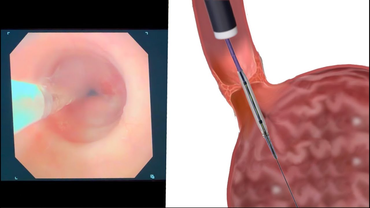 Schatzki's Ring Endoscopic Balloon Dilation to Improve Swallowing