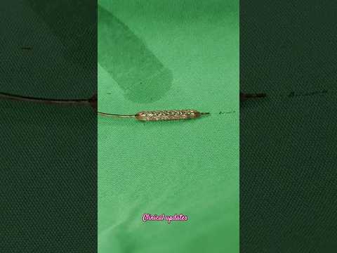 DES (Drug Eluting Stent) #cardiology #angioplasty #angiogram #stent #doctor #cathlab #education