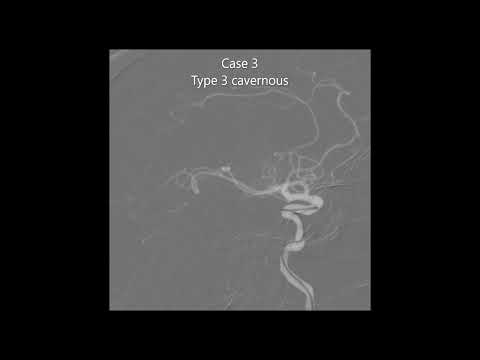 Steam shaped aspiration catheter for mechanical thrombectomy