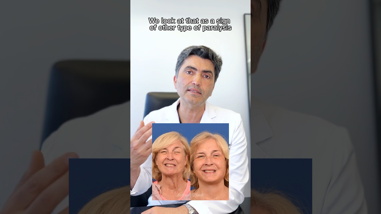 Are you having a stroke or is it Bell’s palsy? #facialparalysis #strokeawareness