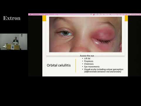 Tonsil Bleed and Orbital cellulitis