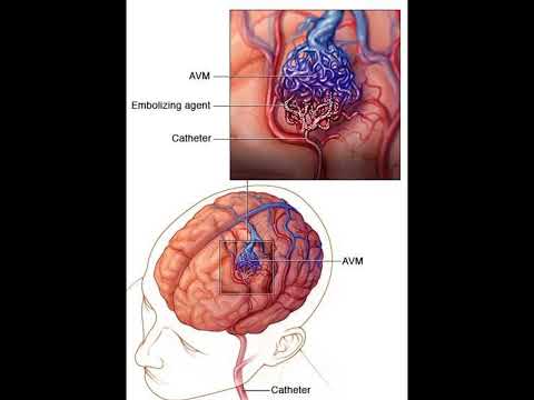 Arteriovenous malformation!!! #doctor #medical #shorts