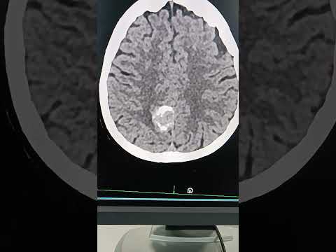 NCCT BRAIN 🧠/Calcified Meningioma#anatomy #ctscan #diagnosis #bones #brain #tuomor#radiology #ct