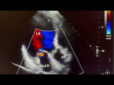 Mitral Valve Tenting, what is it importance?
