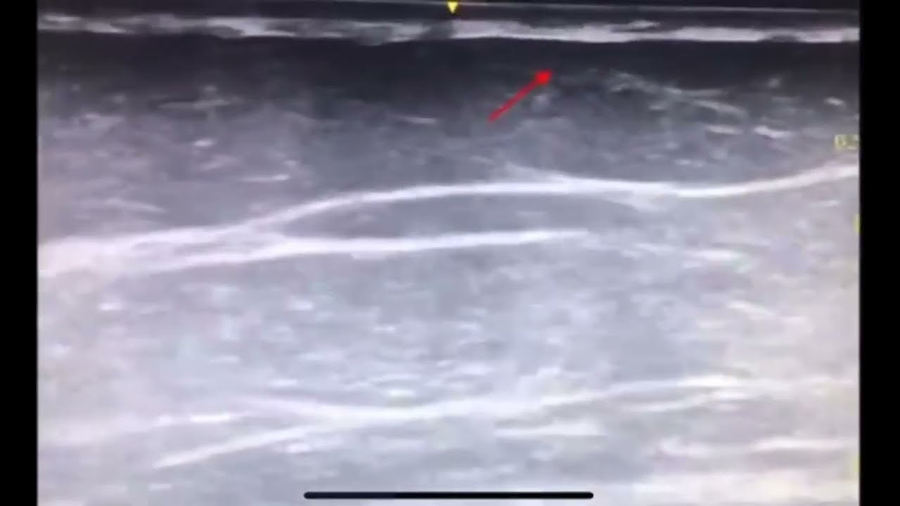 Goldincision: uma abordagem multifatorial no tratamento da celulite ...