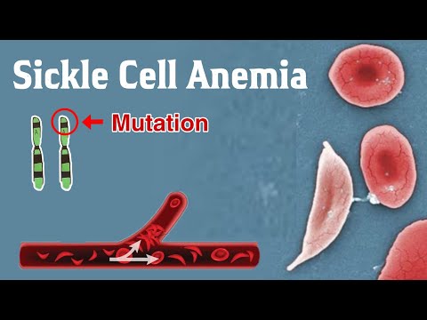 Sickle cell anemia disease | symptoms | treatment | diagnosis in Hindi