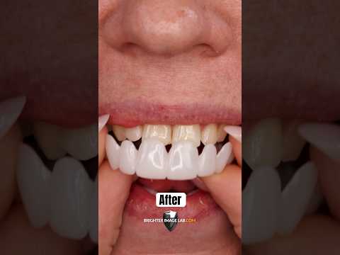 Snap On Veneers: Instant Smile Makeover